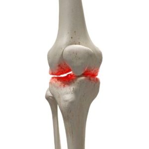 Patella (Kneecap) Dislocation - Assoc. Dr. Murat Kaya